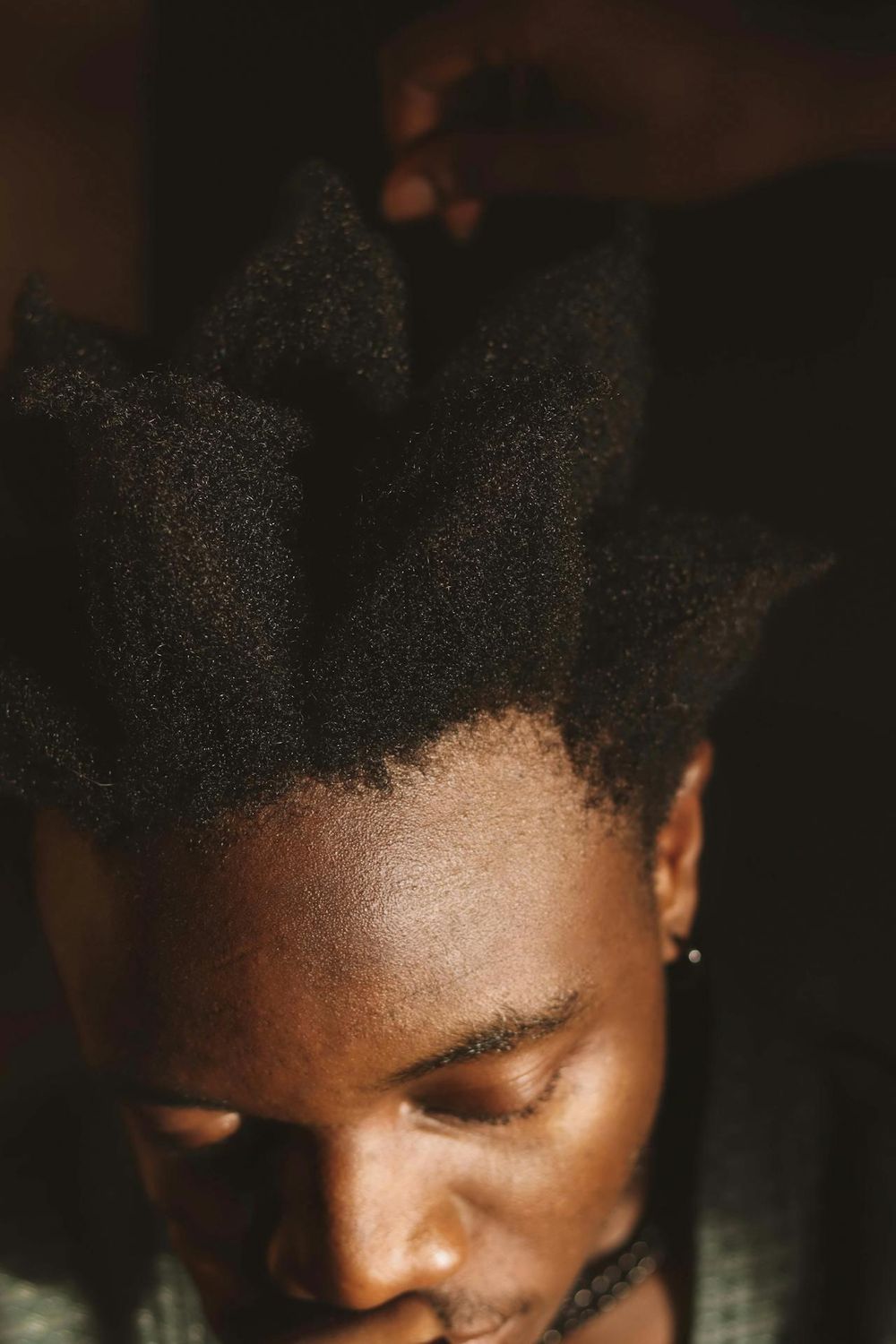Why African hair transplants often fail and how science is evolving to help
