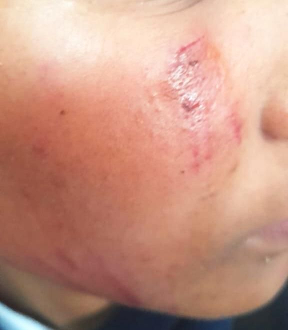 SCHOOL BULLYING LEAVES SCARS