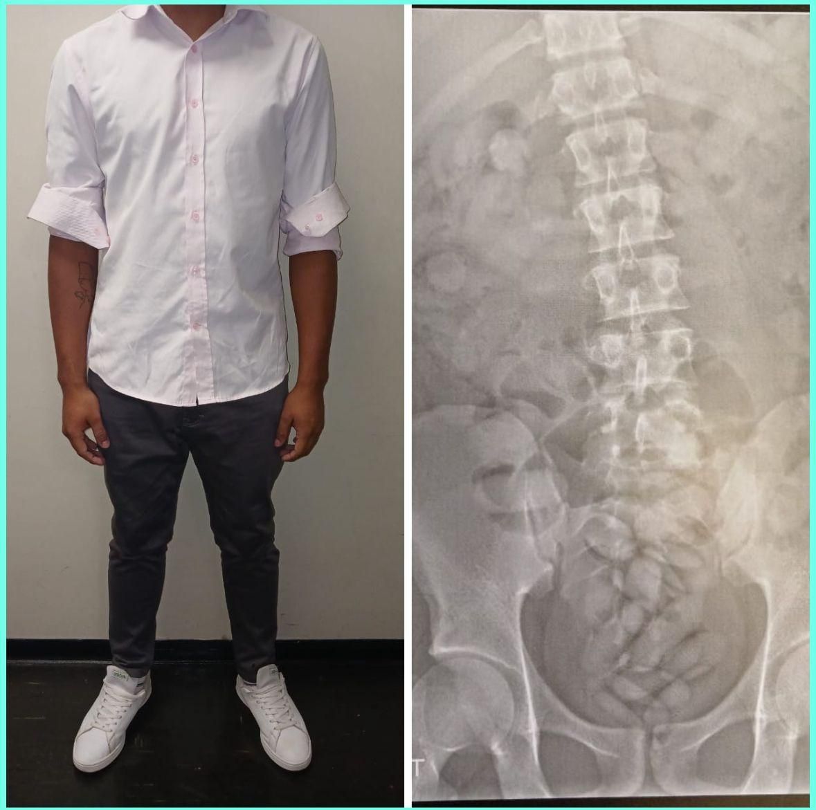 LOOK | Another drug mule, with drugs in his stomach, intercepted at OR ...
