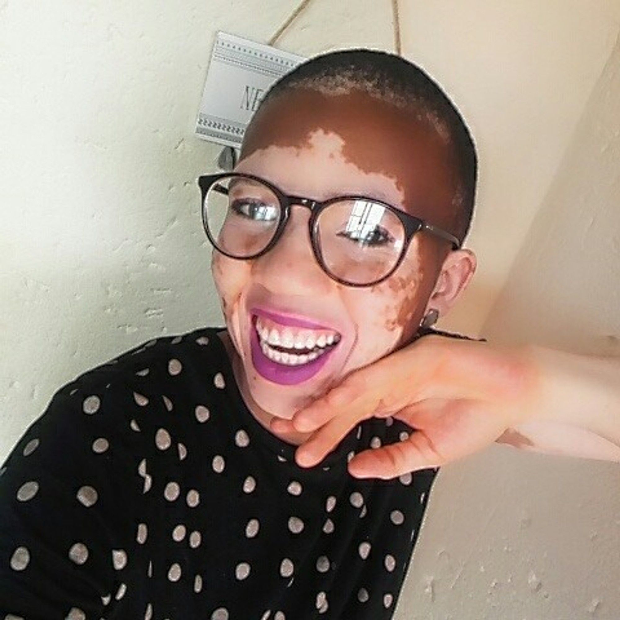 Gaone Tlhong ready to bust myths about vitiligo in black communities