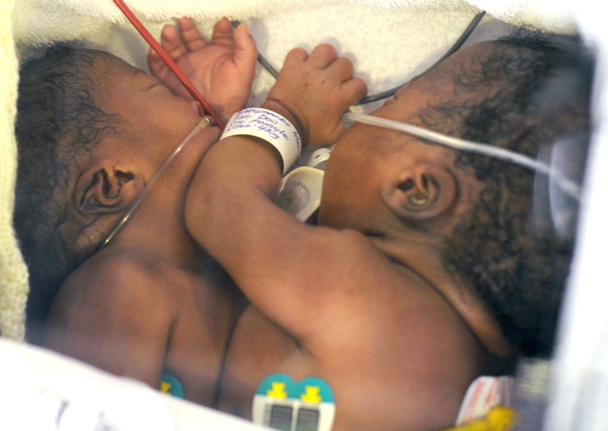 Conjoined twins die in hospital
