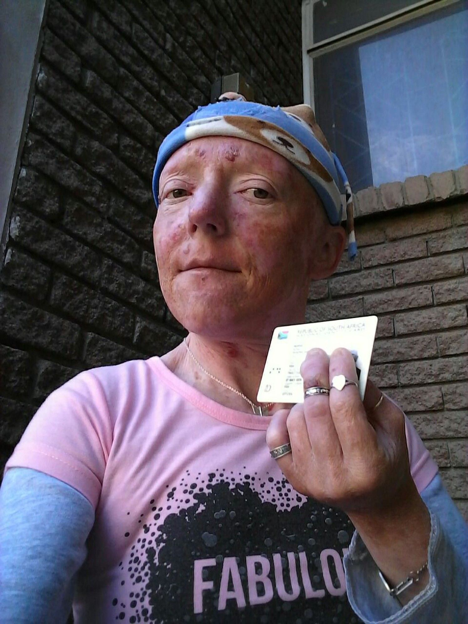 Woman with no fingerprints finally gets smart ID card