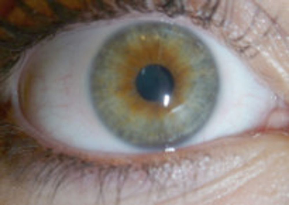 The bionic eye that restores sight