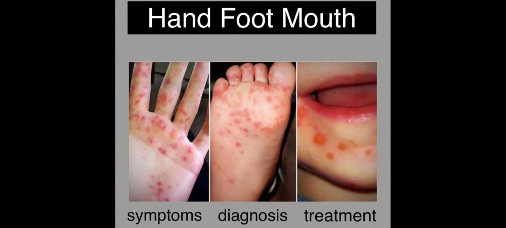 Department notes concerns over Hand, Foot and Mouth Disease (HFMD ...