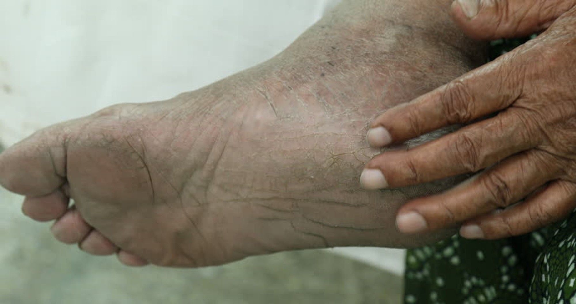 I’m 26 but I have ouma voete