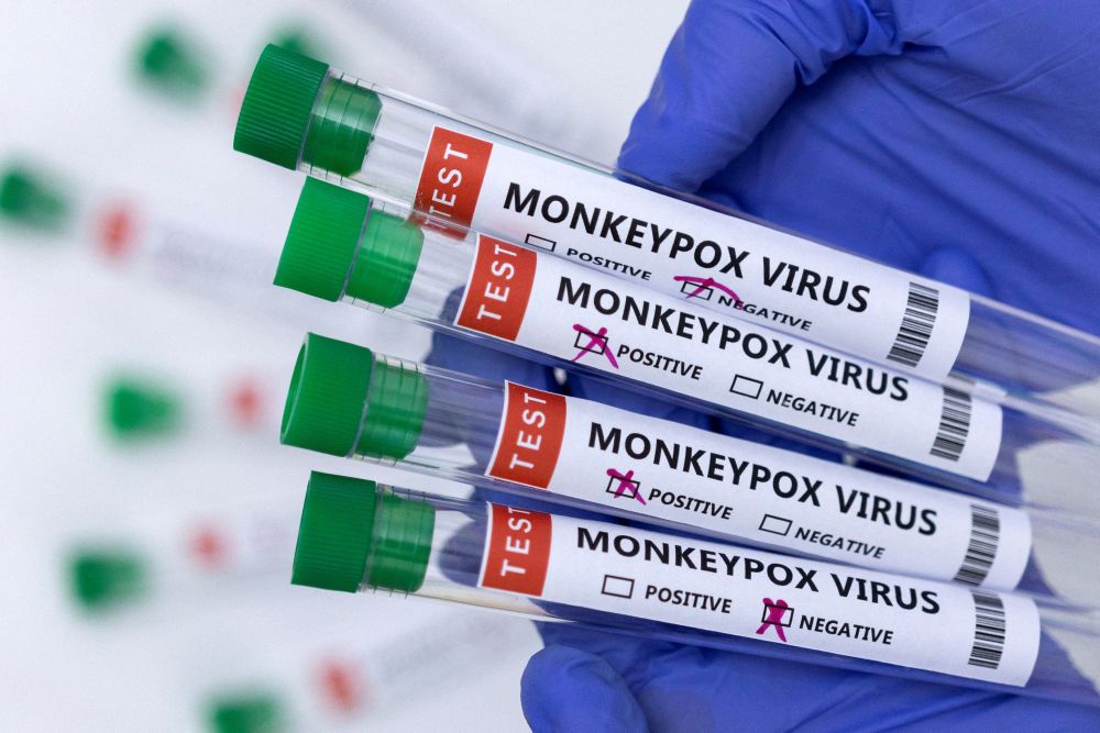 35-year-old Gauteng man tests positive for Monkeypox