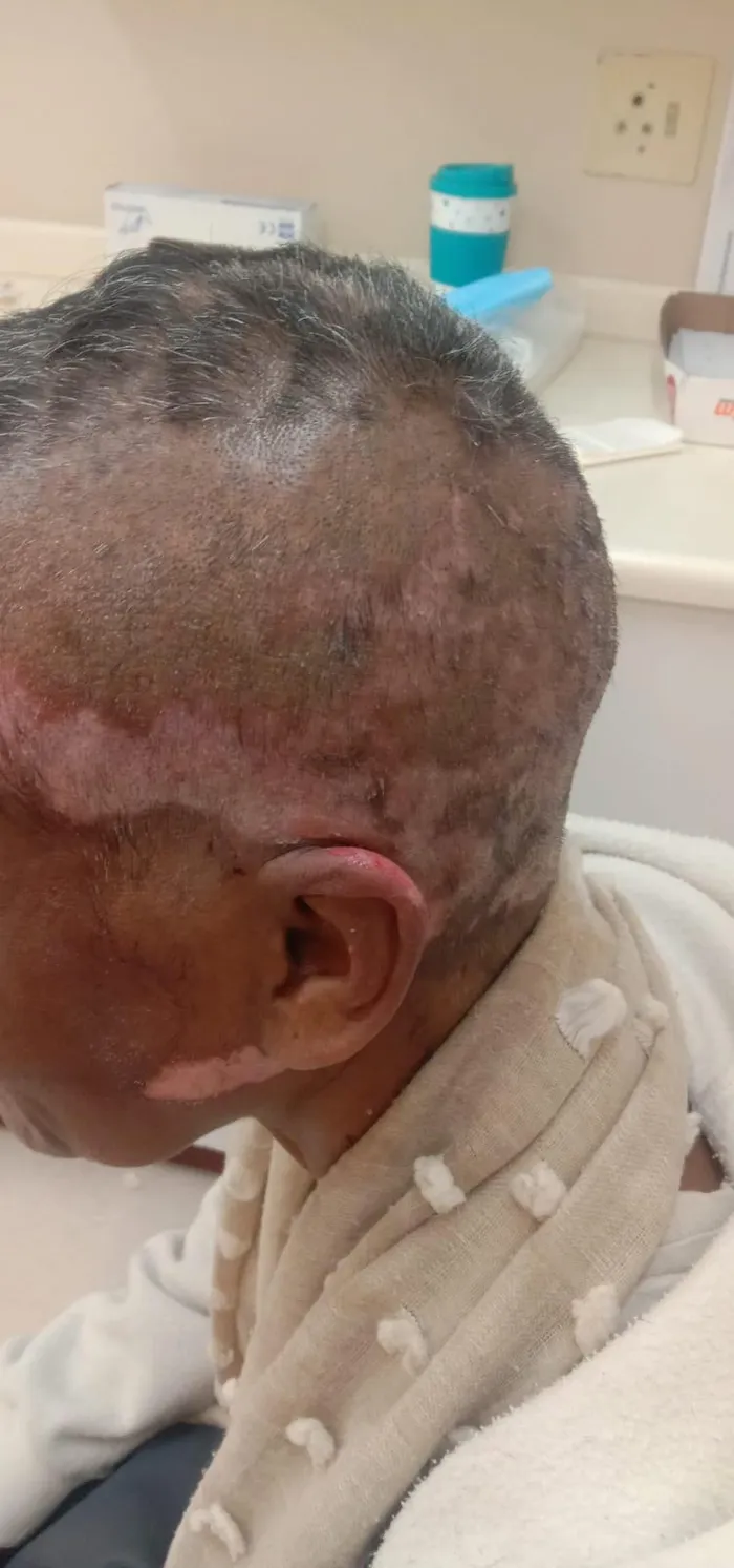 Kaapse vrou healing from burns