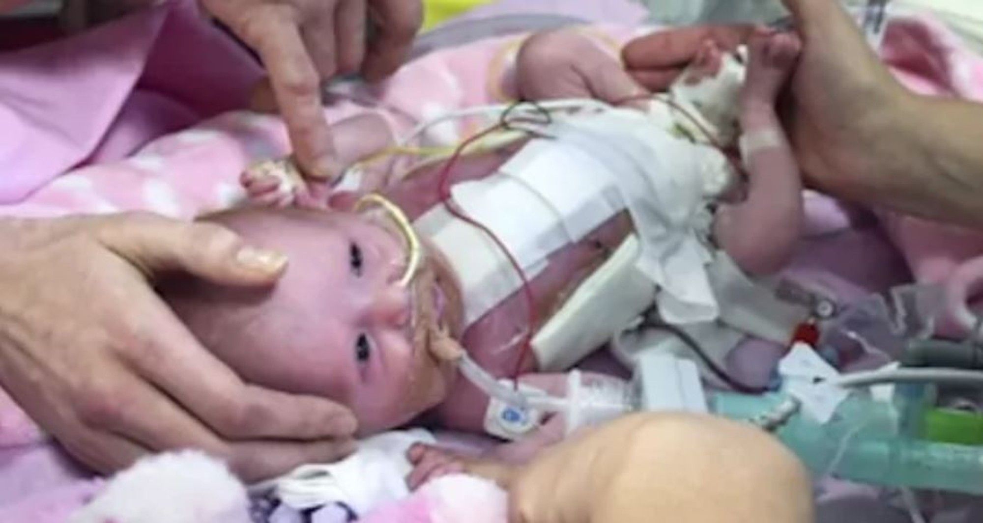 WATCH: This baby girl was born with her heart outside her body and survived