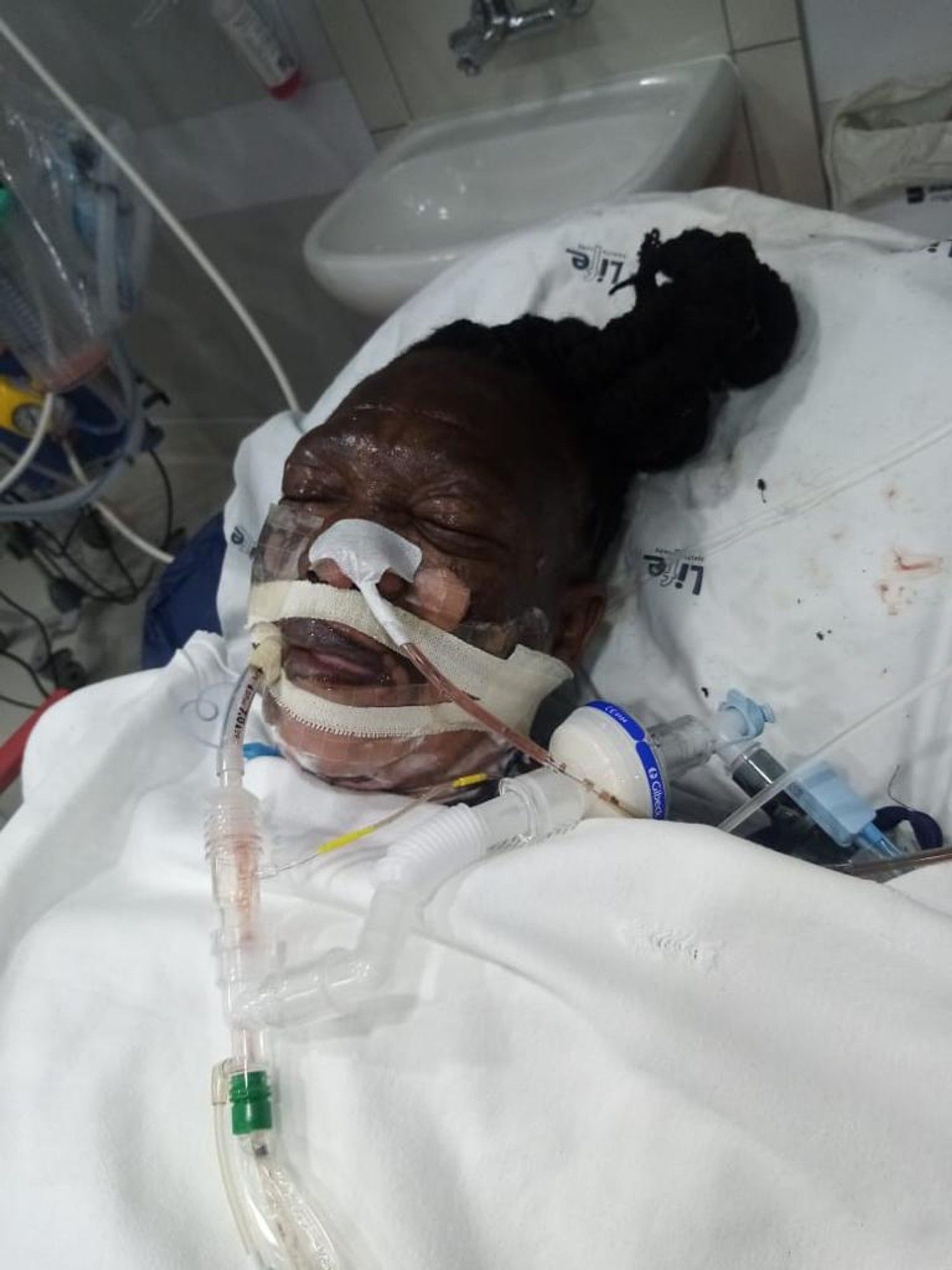 Burn victim fights for her life as suspect dies in police custody
