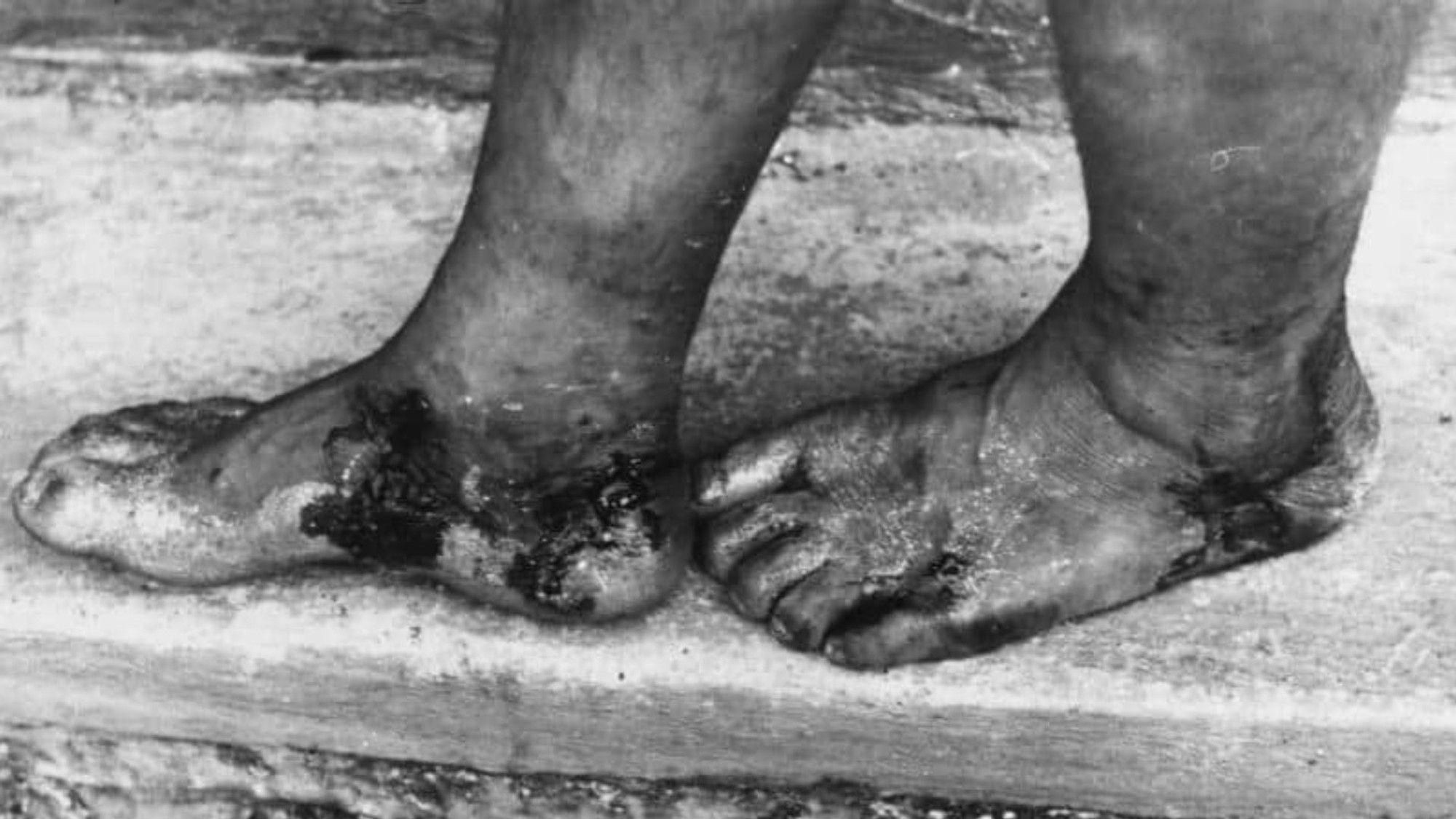 Trench foot, amputations a challenge for Durban homeless