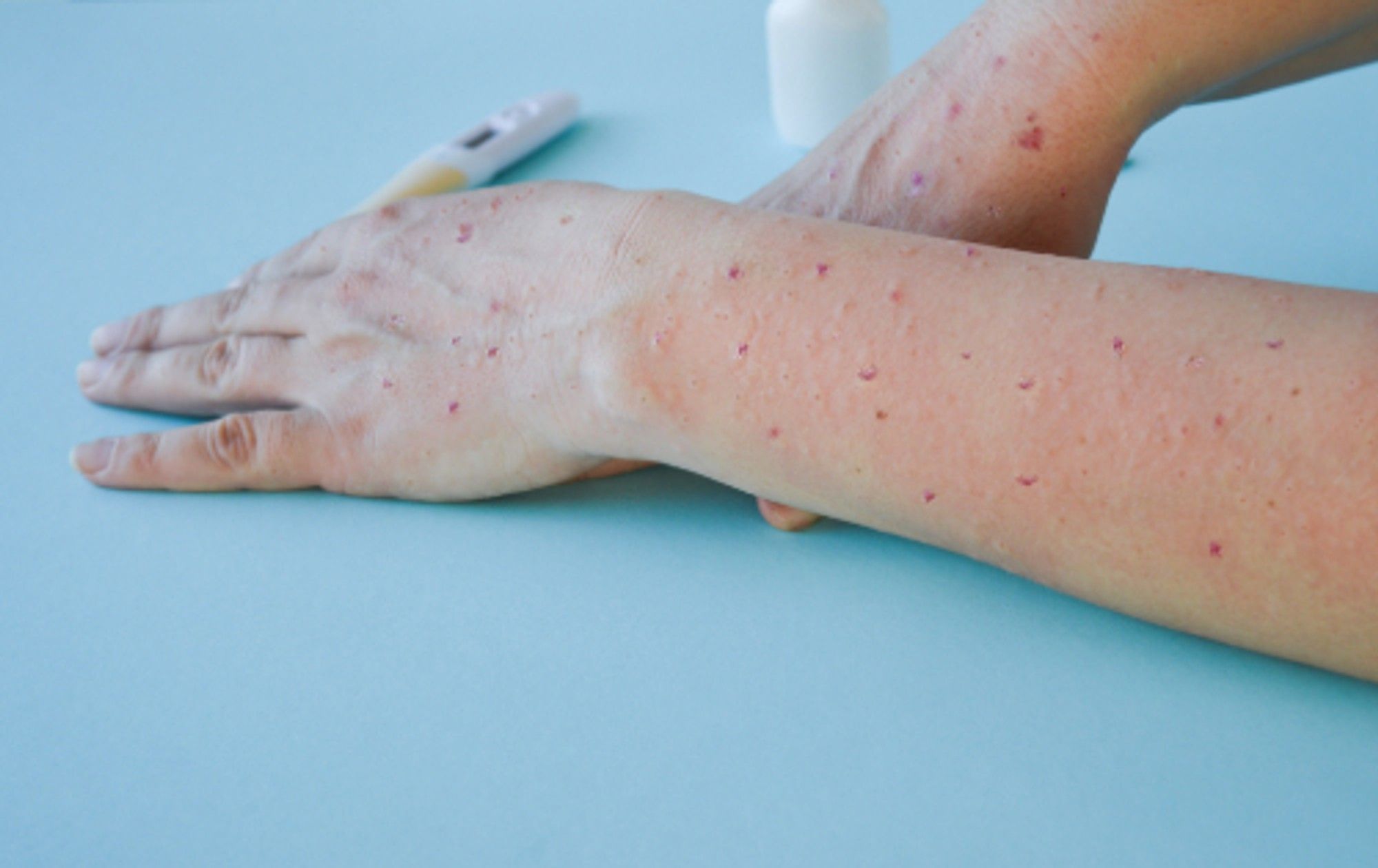 Mpox outbreak in SA: Six confirmed cases, two deaths, here’s what you ...
