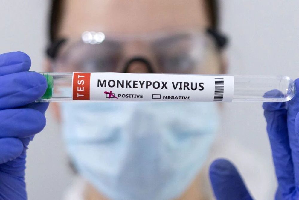 Health authorities urge caution over monkeypox