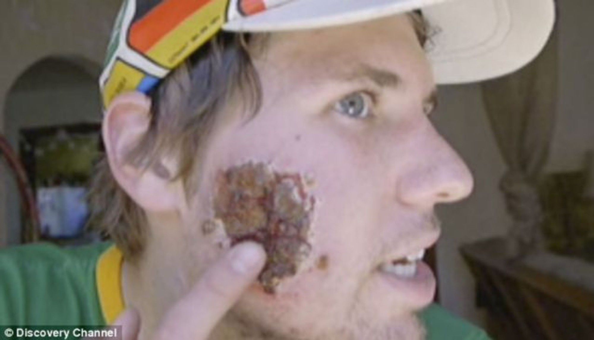 A parasite ate my face