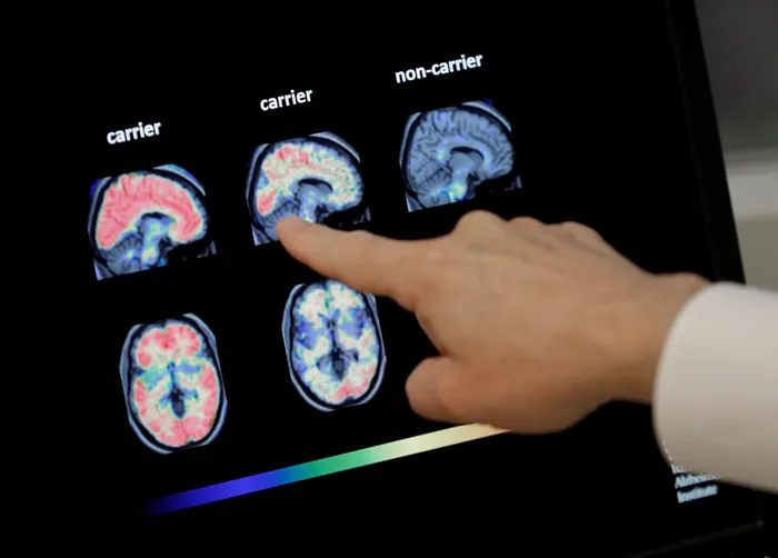 International efforts needed to understand sport's dementia risk: report