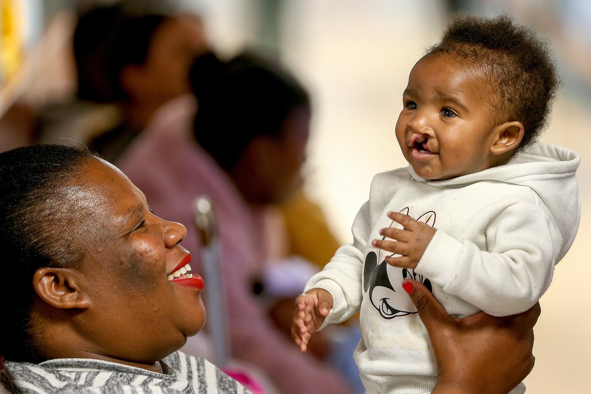 Surgeon from USA to impart new technique for cleft care in SA