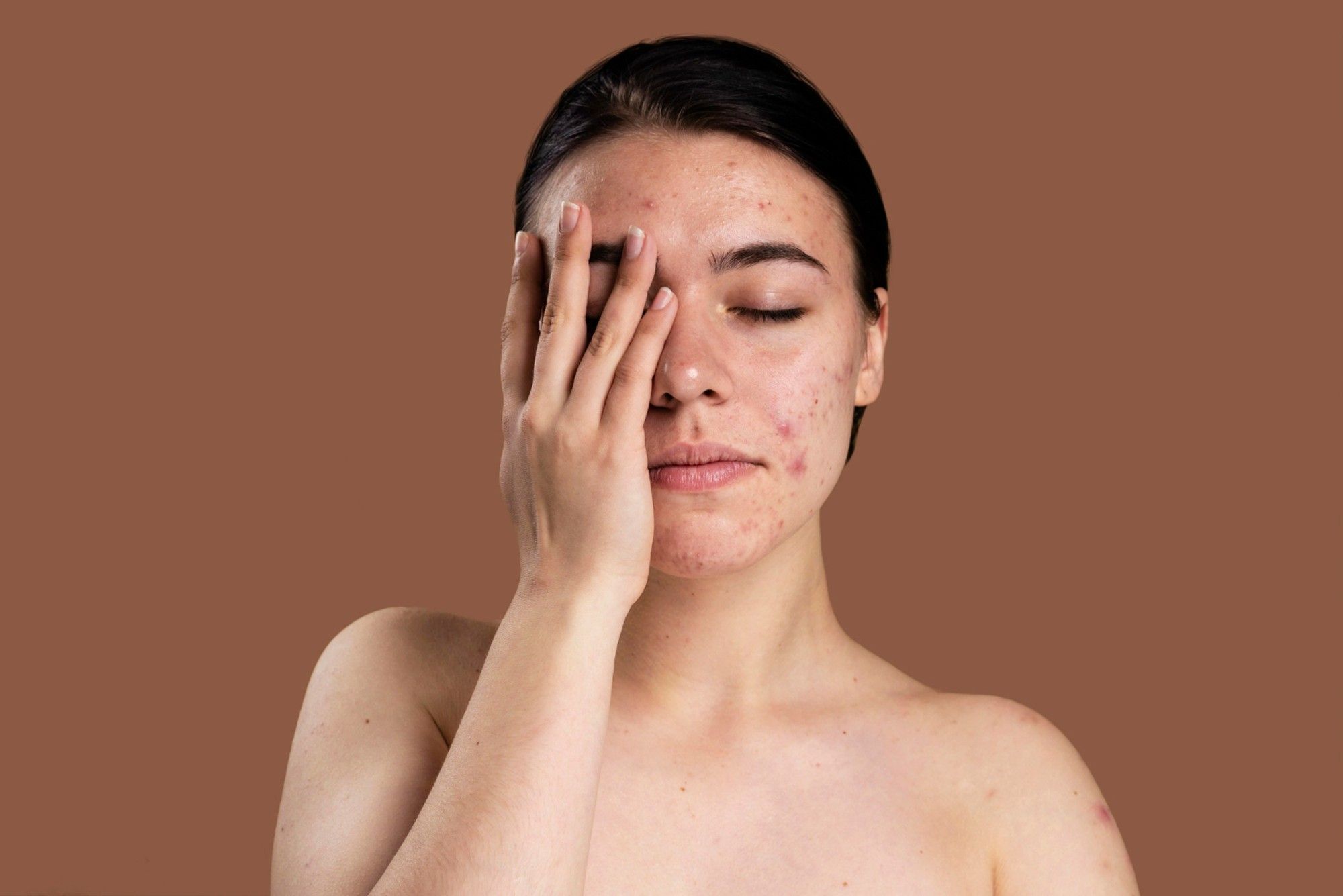 Tips on how to take care of acne-prone skin