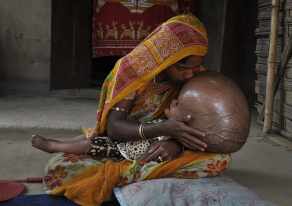 Help for ‘child with swollen head’