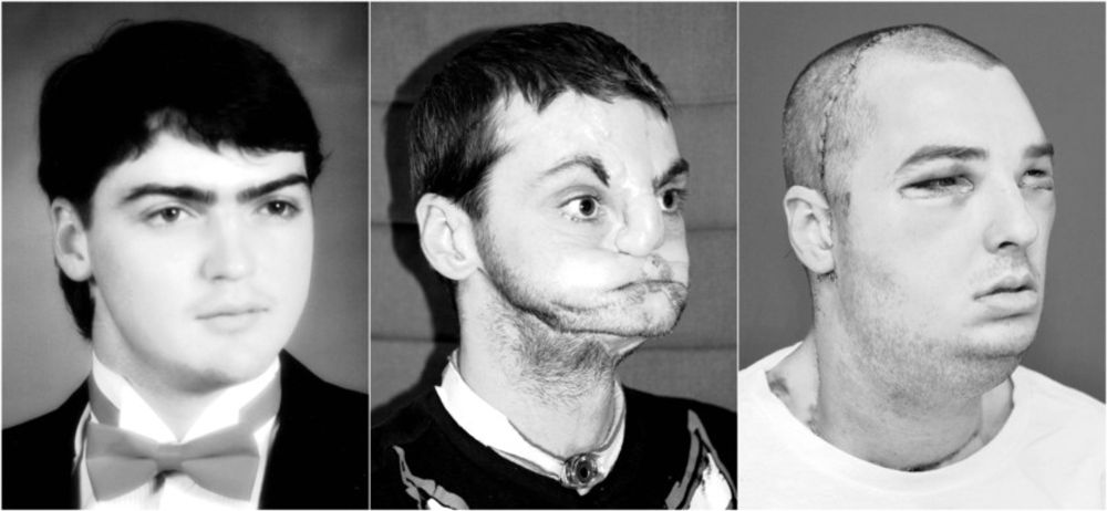 Face transplant patient is able to drop his mask