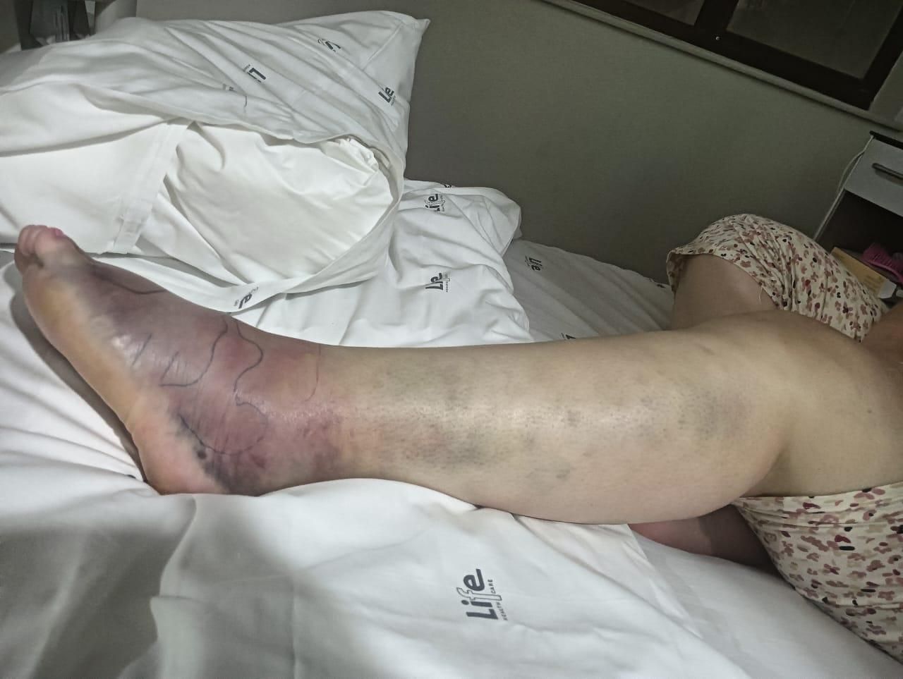 Northern Cape woman survives puff adder bite in Hartenbos